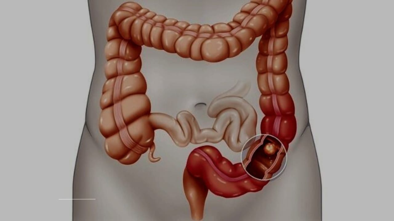 Understanding Colon Cancer: Causes, Symptoms, Prevention, and Treatment Options
